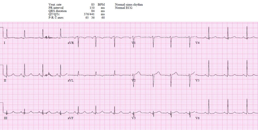 EM Cases | ECG Cases 10: hyperkalemia