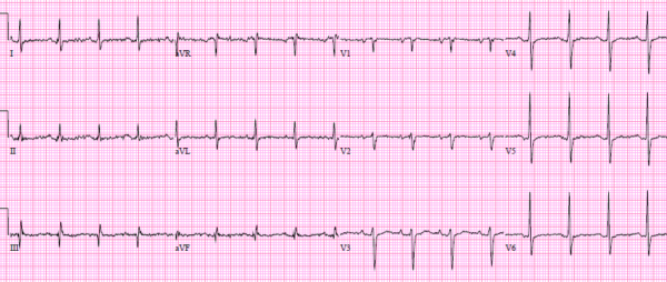 EM Cases | ECG Cases 10: hyperkalemia