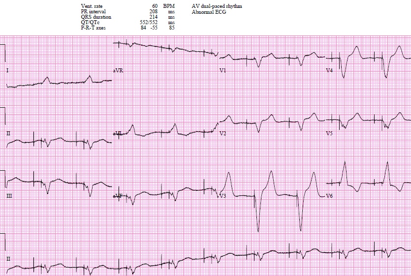 EM Cases | ECG Cases 10: hyperkalemia