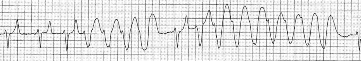 EM Cases | ECG Cases 10: hyperkalemia