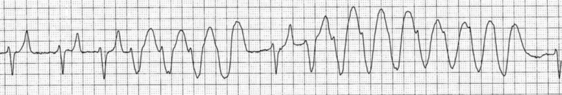 EM Cases | ECG Cases 10: hyperkalemia