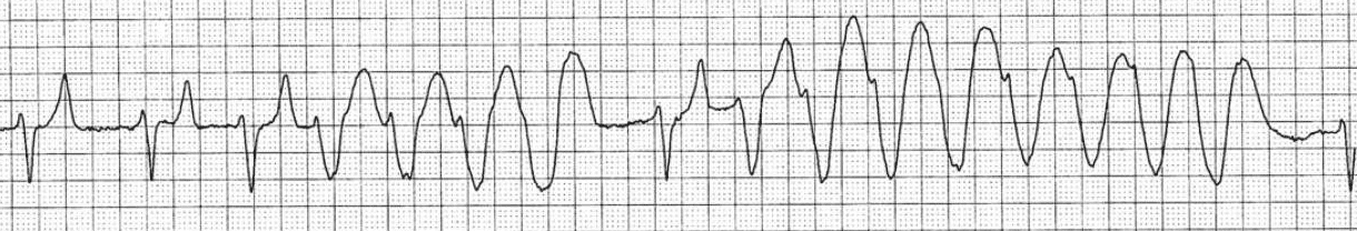 EM Cases | ECG Cases 10: hyperkalemia