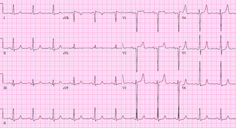 EM Cases | ECG Cases 10: hyperkalemia