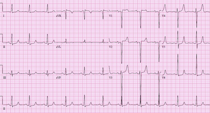 EM Cases | ECG Cases 10: hyperkalemia