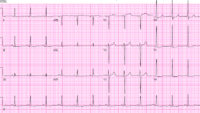 EM Cases | ECG Cases 10: hyperkalemia