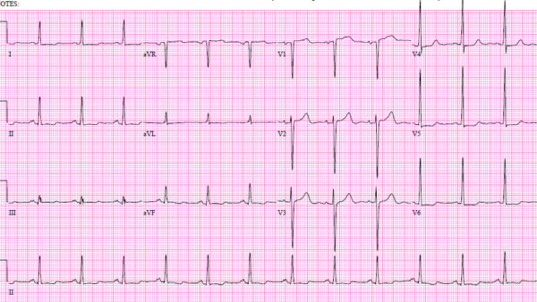 EM Cases | ECG Cases 10: hyperkalemia