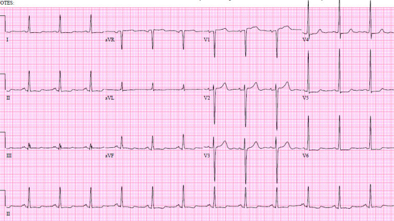 EM Cases | ECG Cases 10: hyperkalemia