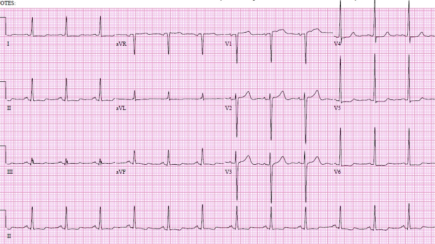 Medicowesome Ecg Changes Seen In Hyperkalemia And