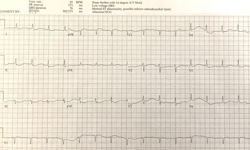 EM Cases | ECG Cases 10: hyperkalemia