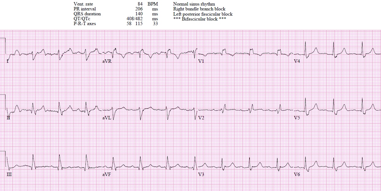 EM Cases | ECG Cases 10: hyperkalemia