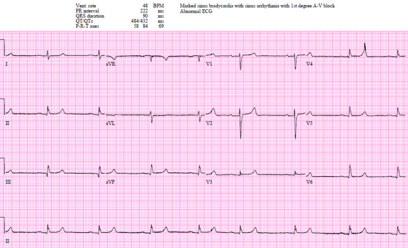 EM Cases | ECG Cases 10: hyperkalemia