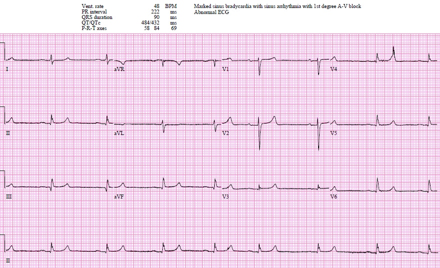 EM Cases | ECG Cases 10: hyperkalemia