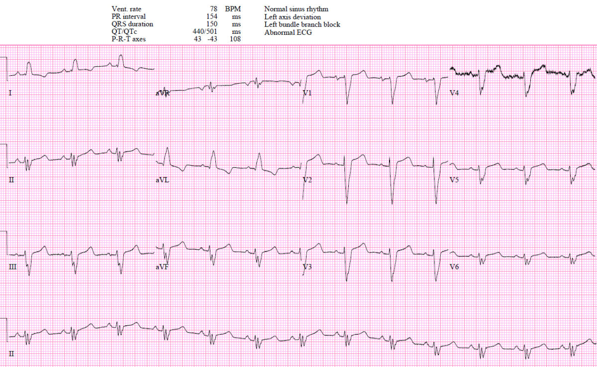 LBBB and Occlusion MI | ECG Cases | Emergency Medicine Cases