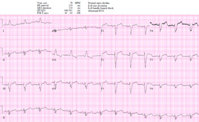 LBBB and Occlusion MI | ECG Cases | Emergency Medicine Cases