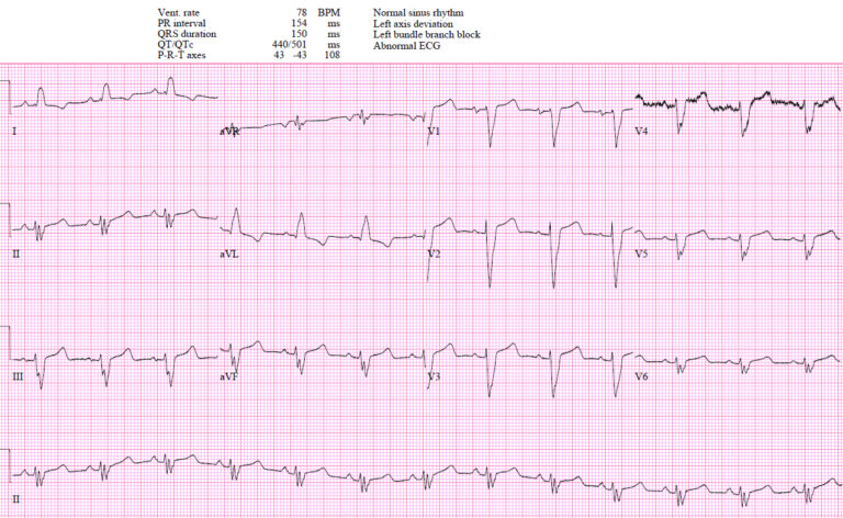 LBBB and Occlusion MI | ECG Cases | Emergency Medicine Cases