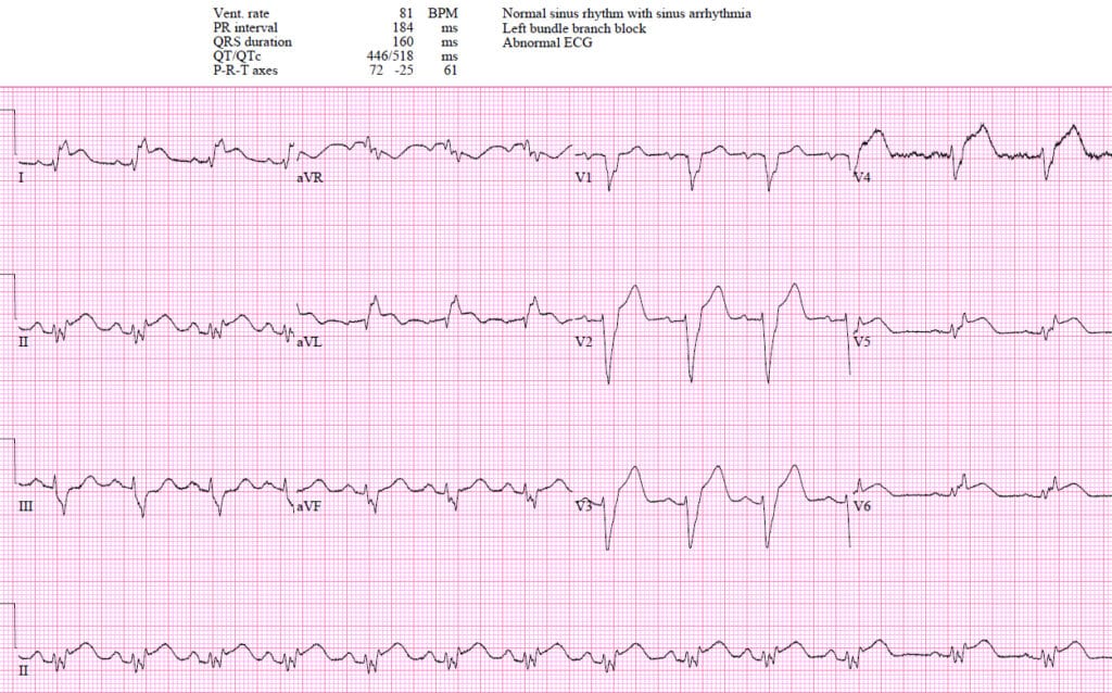 LBBB and Occlusion MI | ECG Cases | Emergency Medicine Cases