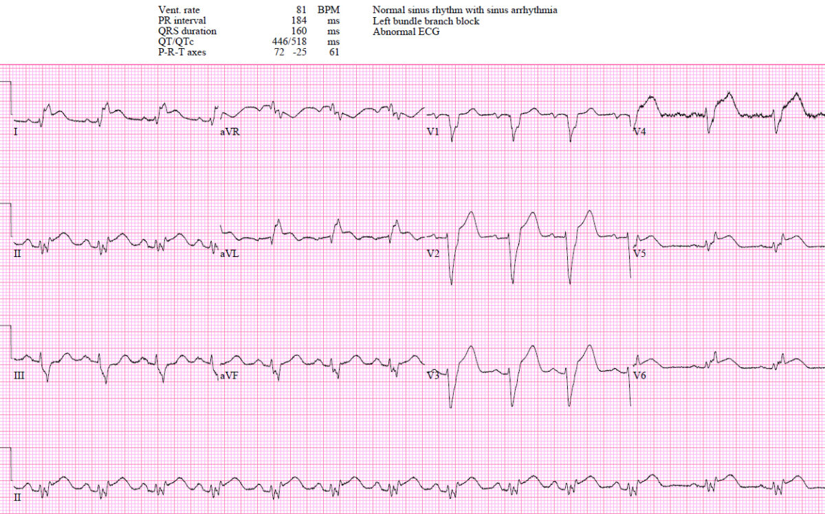 LBBB and Occlusion MI | ECG Cases | Emergency Medicine Cases