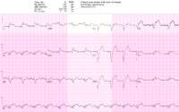 LBBB and Occlusion MI | ECG Cases | Emergency Medicine Cases