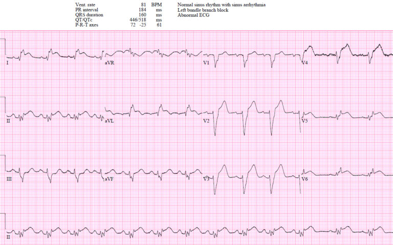 LBBB and Occlusion MI | ECG Cases | Emergency Medicine Cases