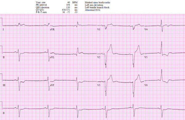 LBBB and Occlusion MI | ECG Cases | Emergency Medicine Cases
