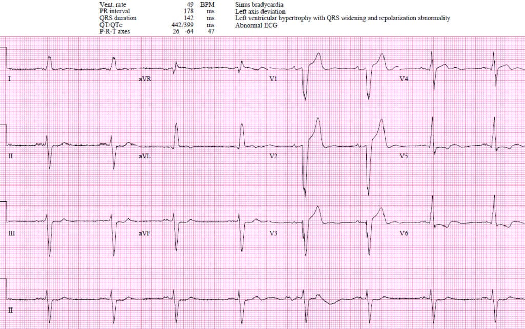 LBBB and Occlusion MI | ECG Cases | Emergency Medicine Cases