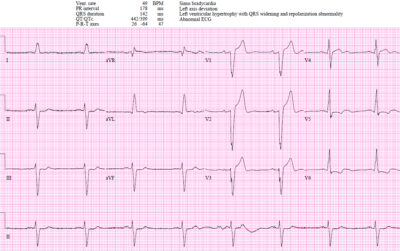 LBBB and Occlusion MI | ECG Cases | Emergency Medicine Cases