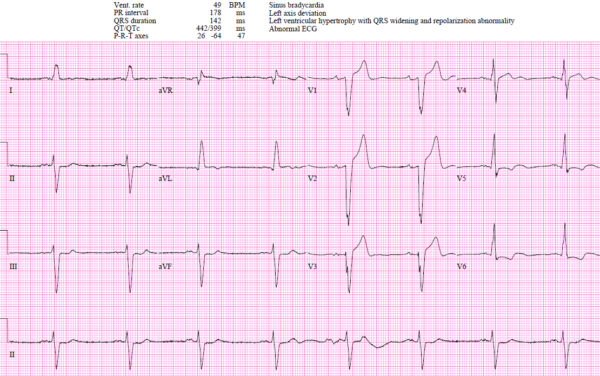 LBBB and Occlusion MI | ECG Cases | Emergency Medicine Cases
