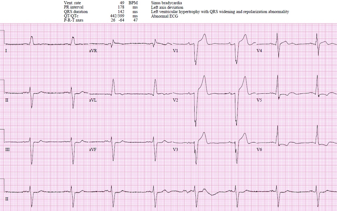 LBBB and Occlusion MI | ECG Cases | Emergency Medicine Cases