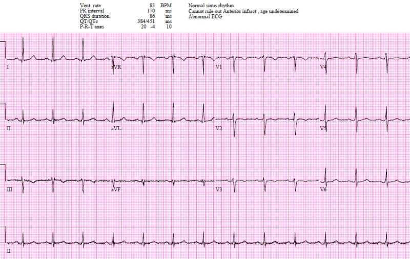 LBBB and Occlusion MI | ECG Cases | Emergency Medicine Cases