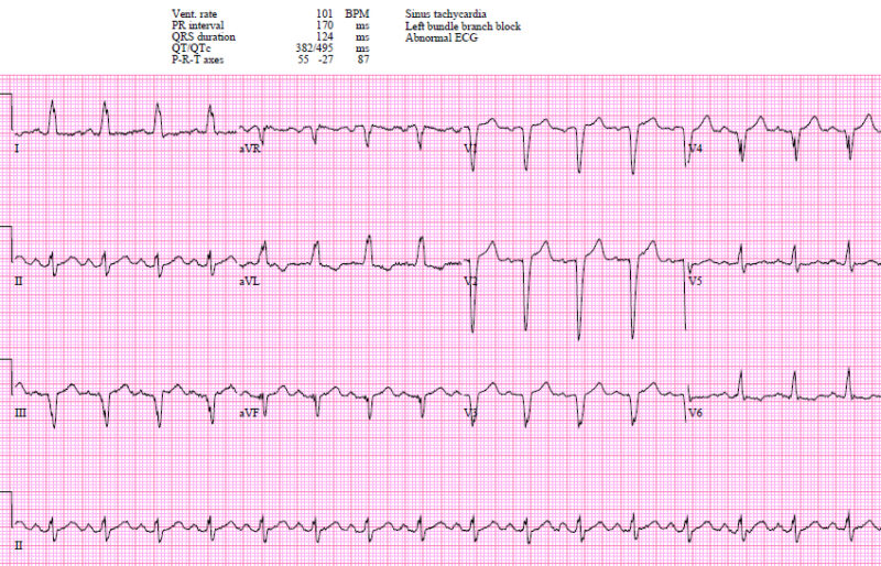 LBBB and Occlusion MI | ECG Cases | Emergency Medicine Cases