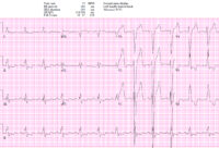 LBBB and Occlusion MI | ECG Cases | Emergency Medicine Cases