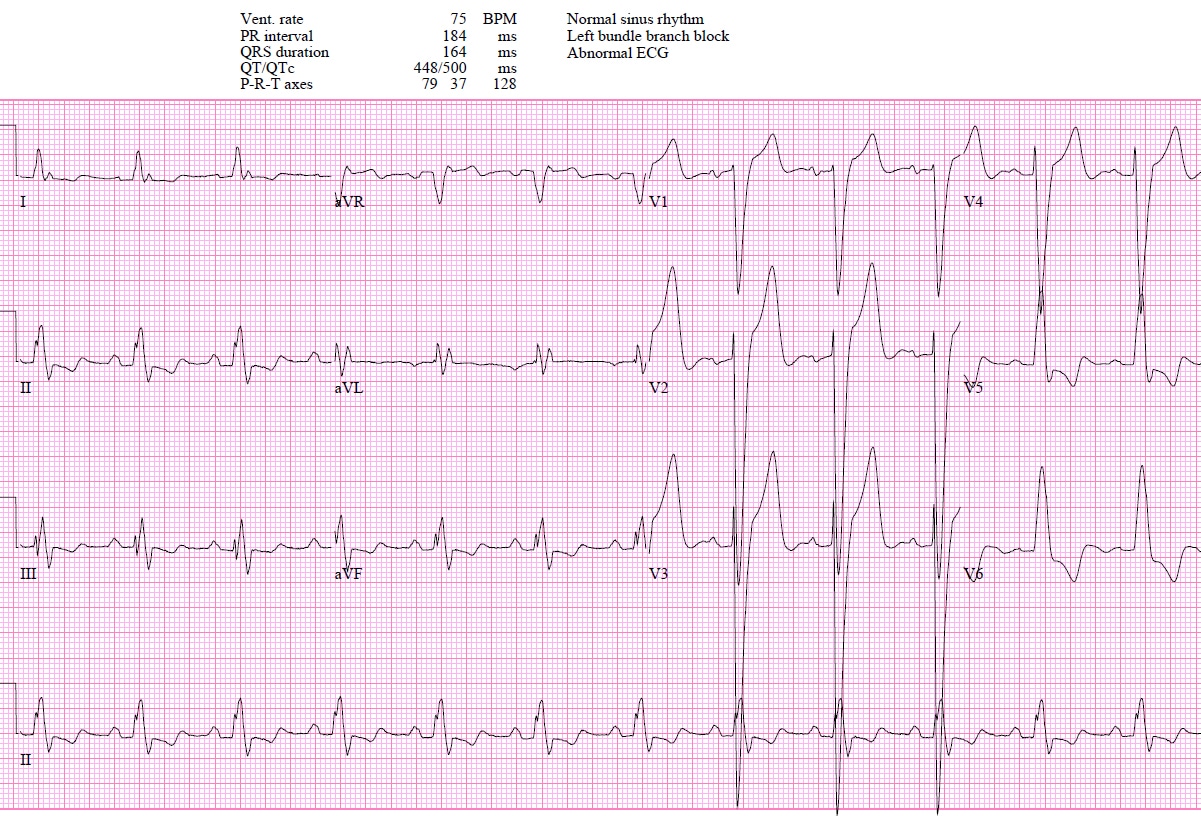 LBBB and Occlusion MI | ECG Cases | Emergency Medicine Cases