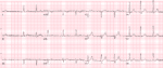 EM Cases | ECG cases 12: RBBB + Occlusion MI