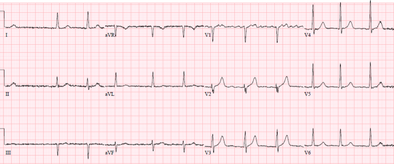 EM Cases | ECG cases 12: RBBB + Occlusion MI