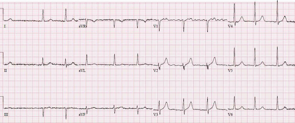 EM Cases | ECG cases 12: RBBB + Occlusion MI