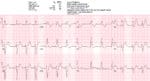 EM Cases | ECG cases 12: RBBB + Occlusion MI
