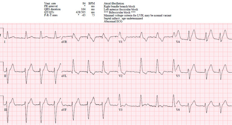 EM Cases | ECG cases 12: RBBB + Occlusion MI