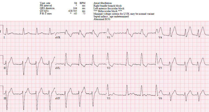 EM Cases | ECG cases 12: RBBB + Occlusion MI