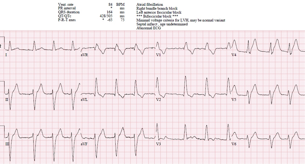 EM Cases | ECG cases 12: RBBB + Occlusion MI