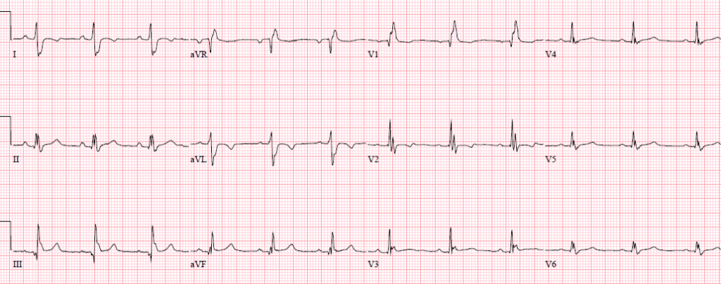 EM Cases | ECG cases 12: RBBB + Occlusion MI