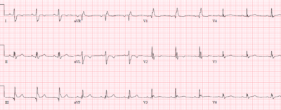 EM Cases | ECG cases 12: RBBB + Occlusion MI