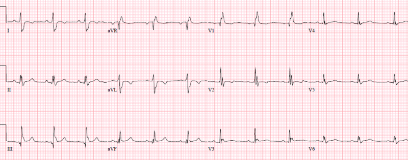 EM Cases | ECG cases 12: RBBB + Occlusion MI