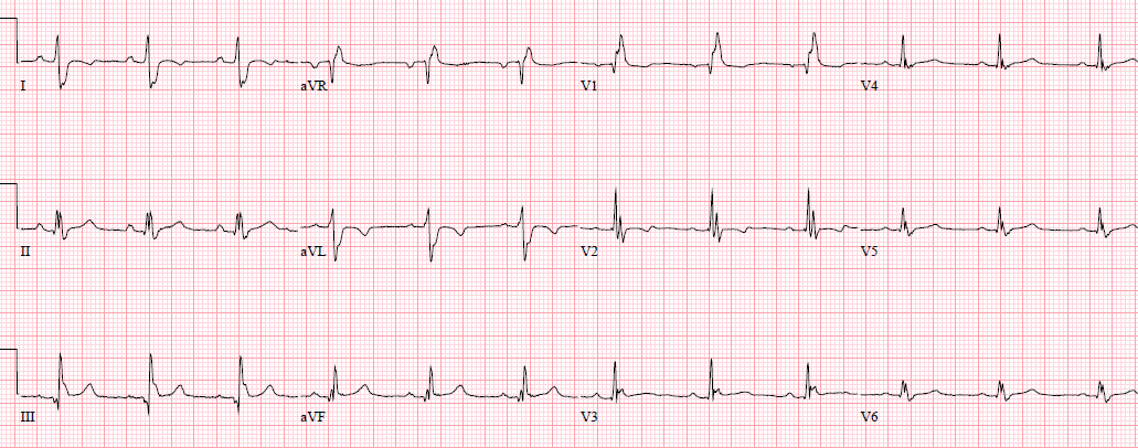 EM Cases | ECG cases 12: RBBB + Occlusion MI