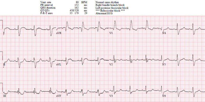 Casos EM | Casos de ECG 12: BRD + Oclusión IM - blogfarmaceutico.com