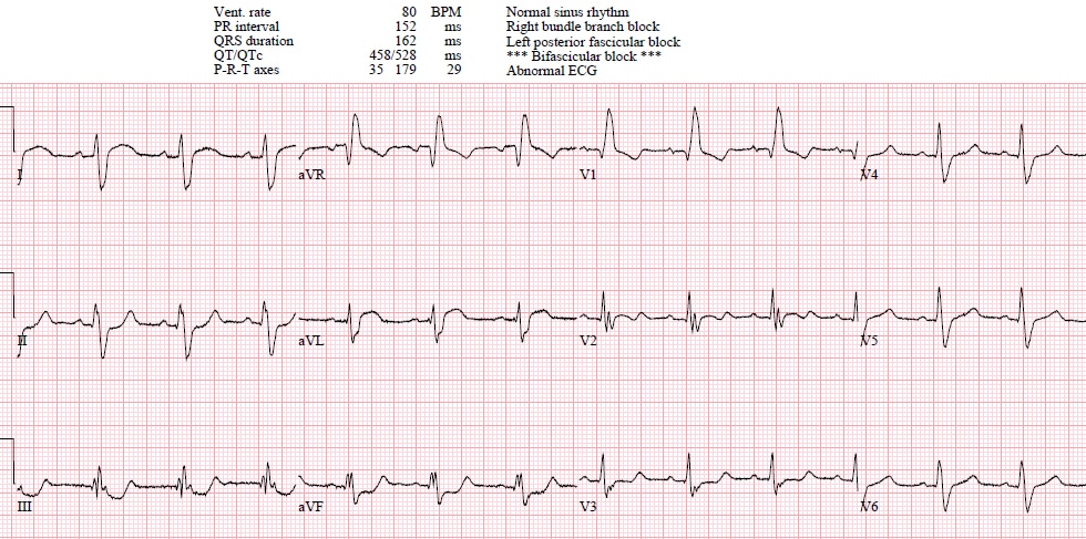 EM Cases | ECG cases 12: RBBB + Occlusion MI