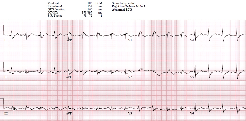 EM Cases | ECG cases 12: RBBB + Occlusion MI