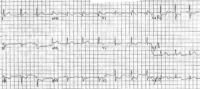 EM Cases | ECG cases 12: RBBB + Occlusion MI