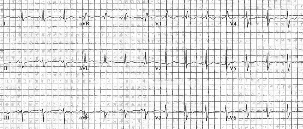EM Cases | ECG cases 12: RBBB + Occlusion MI