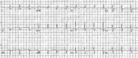 EM Cases | ECG cases 12: RBBB + Occlusion MI