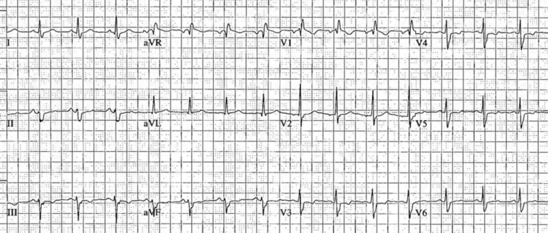 EM Cases | ECG cases 12: RBBB + Occlusion MI